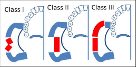 Zygomatic Complex Fracture Classification Epos™