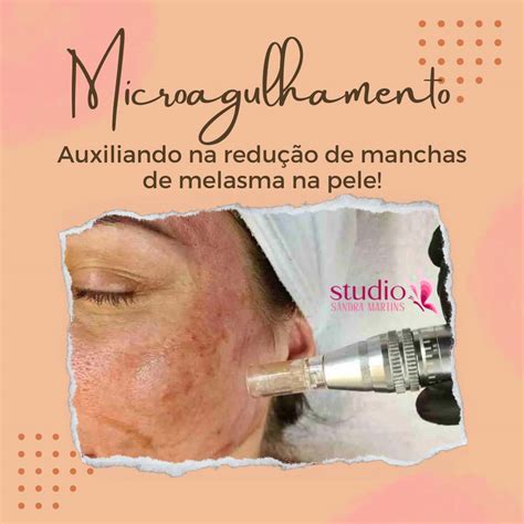 O Guia Completo Dos Cuidados Pós Microagulhamento Em Brasília Para Uma Pele Radiante Sandra