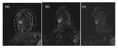 Figure 1 From Magnetic Resonance Imaging Tumor Regression Shrinkage Patterns After Neoadjuvant
