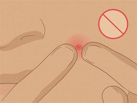 Ways To Get Rid Of Pimples Naturally Sea Salt Method WikiHow