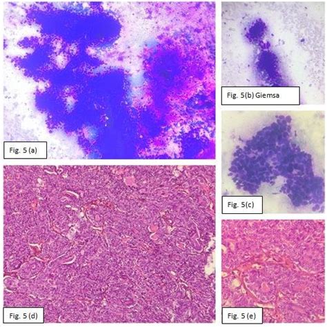 Basal Cell Adenoma Fig 5 A And Fig 5 B Cohesive Small Basaloid Download Scientific Diagram
