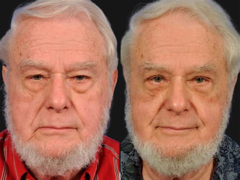 Droopy Eyelids Ptosis Before And After Photos W Cosmetic Surgery