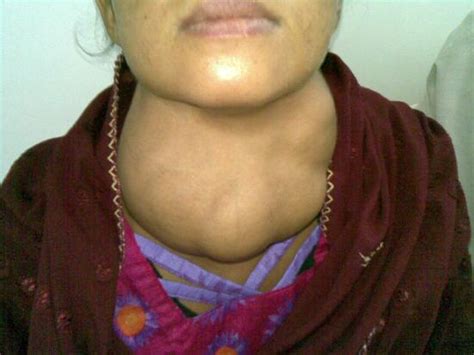 7 12 The Thyroid Gland Medicine Libretexts