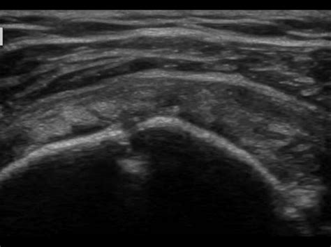 Musculoskeletal Joints And Tendons 61 Shoulder Case 615 Rotator