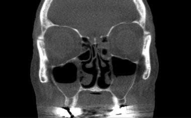 Maxillary And Ethmoid Sinus Disease