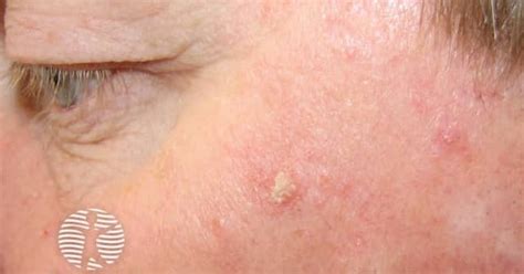 Actinic Keratosis On The Face Signs Causes Treatment Prevention