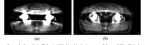 figure 1 from the impact of a metal artefact reduction algorithm on