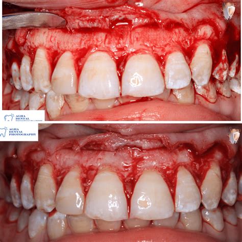 Ostectomy Dental Procedure At Peggy Hodges Blog