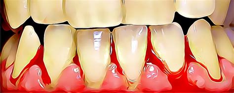 Bleeding Gums When Flossing Brushing Teeth Archer Dental