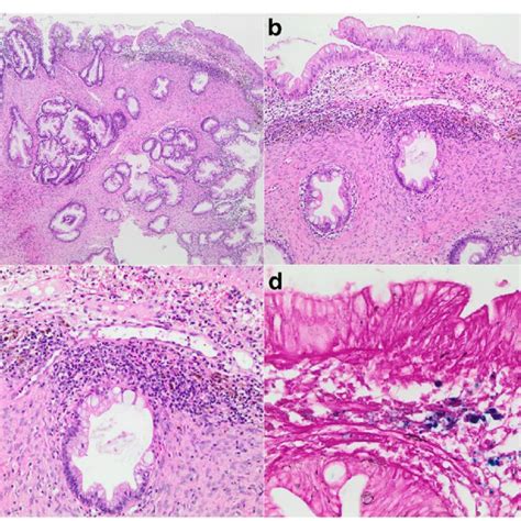 Pdf Colonic Perineurioma Benign Fibroblastic Polyp Case Report And Review Of The Literature