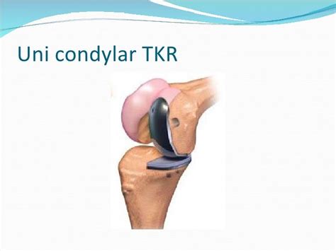 Total Knee Replacement Tkr Ppt
