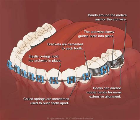 Braces Philadelphia Pa Bala Cynwyd Pa Bensalem Pa Metal Braces Kellyn Hodges Orthodontics