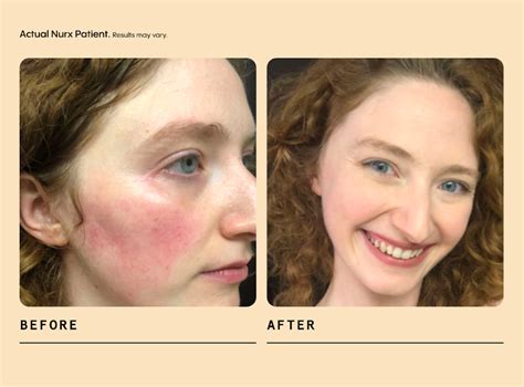 Rosacea Treatment Nurx™