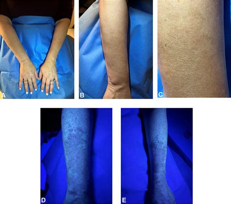 Acquired Brachial Cutaneous Dyschromatosis Jaad Case Reports