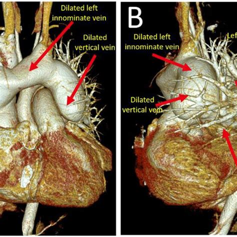 A Three Dimensional Cardiac Ct Scan Further Delineated The Supracardiac Download Scientific