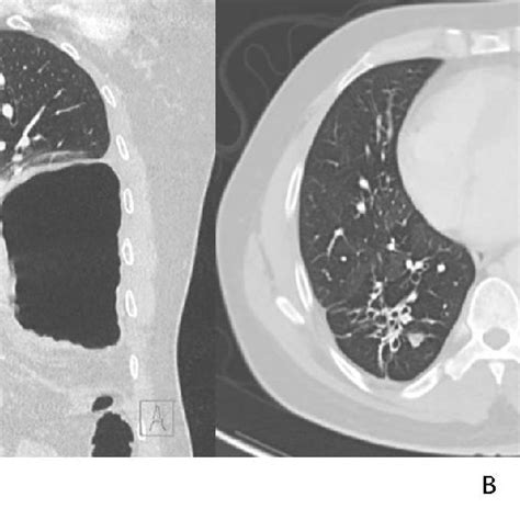 A Axial Thorax Ct Lung Window Demonstrates Air Filled Structure Download Scientific Diagram