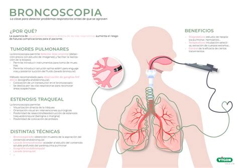 Broncoscopia La Clave Para Detectar Problemas Respiratorios Antes De
