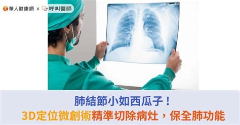 肺結節小如西瓜子 3D定位微創術精準切除病灶保全肺功能 華人健康網 專業即時優質的健康新聞及資訊分享平台業即時優質的健康新聞及