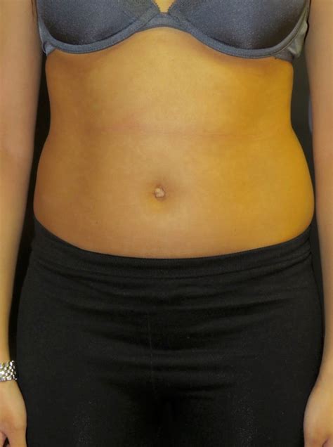The Latest Plastic Surgery Trend Involves Your Belly Button Womens Health