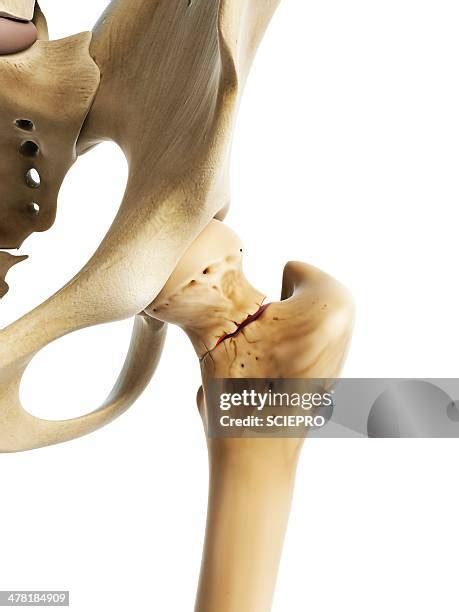 Pelvic Fractures Photos And Premium High Res Pictures Getty Images