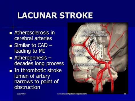 Lacunar Stroke Causes Symptoms And Treatments Global Treatment