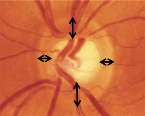 Glaucoma Basics Flashcards Quizlet