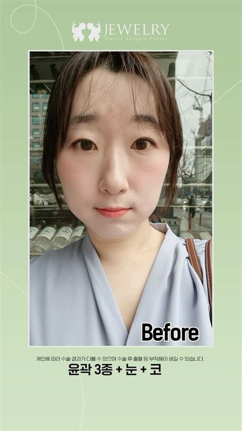 쥬얼리성형외과 나 오이였는데 사람된 썰 푼다 💎전후사진 인스타 Jewelryps Krr 💎카카오톡 쥬얼리성형외과 💎대표전화 02 541 2711 💎유튜브
