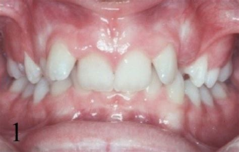 Occlusion Review Flashcards Quizlet