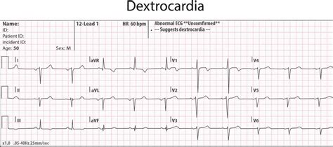 Dextrocardia Types Dextrocardia Situs Inversus Causes Symptoms Ecg And Complications