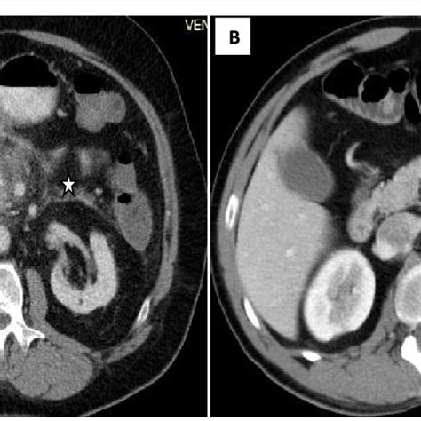 Ctsi Vs Mortality And Morbidity Download Table