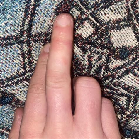 Is This Chilblains R Raynauds