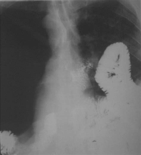 Jejunal Loop Herniation In The Chest After A Cardia Resection Download Scientific Diagram