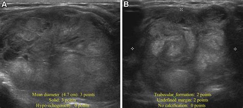 Subacute Thyroiditis Ultrasound Subacute Thyroiditis Wikipedia