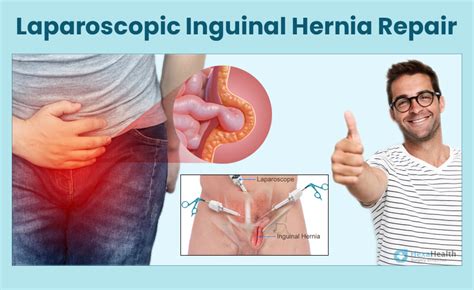 Laparoscopic Inguinal Hernia Drayman Abd Elha Laparoscopic Inguinal