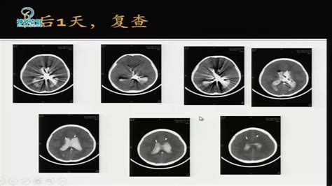 夏鹰教授：脑血管畸形介入治疗的并发症及防治 脑医汇