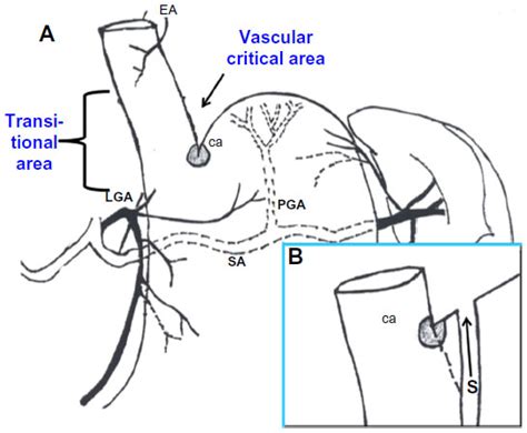 Longitudinal Sleeve Gastrectomy Current Perspectives Oas