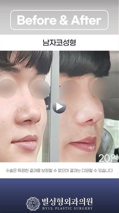 남자코성형 직선으로 오똑하고 남성미 넘치게 남자코수술 남자직선코 직선코성형 직선코수술 Youtube