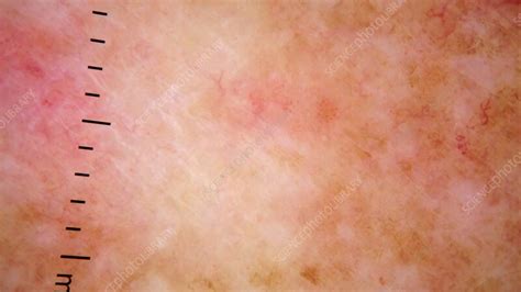 Basal Cell Carcinoma Blink Dermoscopy Stock Video Clip K0113003