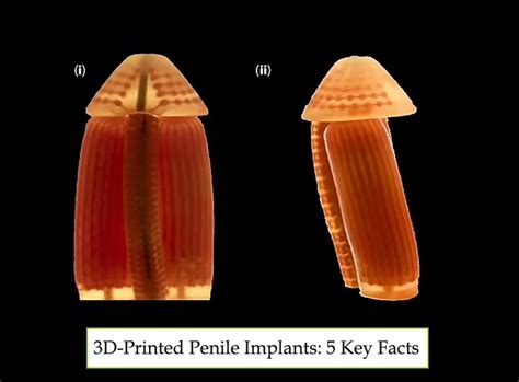 3d Printed Penile Implants Top 5 Facts You Should Know