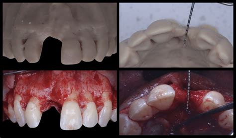 Digital Trends And 3d Technologies In Bone Augmentation Procedures