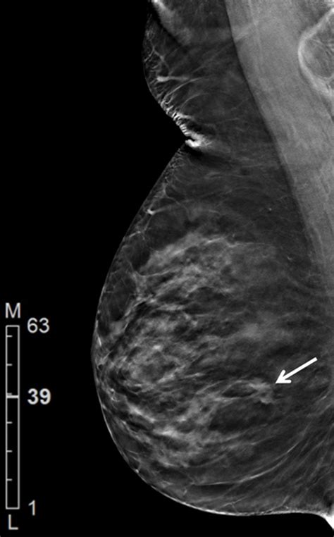 Digital Breast Tomosynthesis Concepts And Clinical Practice Pmc