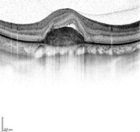 Myopic Choroidal Neovascularization With Mild Activity Download Scientific Diagram