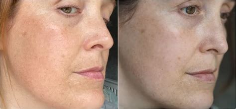 CurrentBody LED Mask Review Before After Photos
