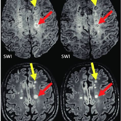 Pdf Evaluation Of The ‘ring Sign And The ‘core Sign As A Magnetic
