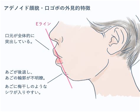 出っ歯口ゴボとは 出っ歯口ゴボとは