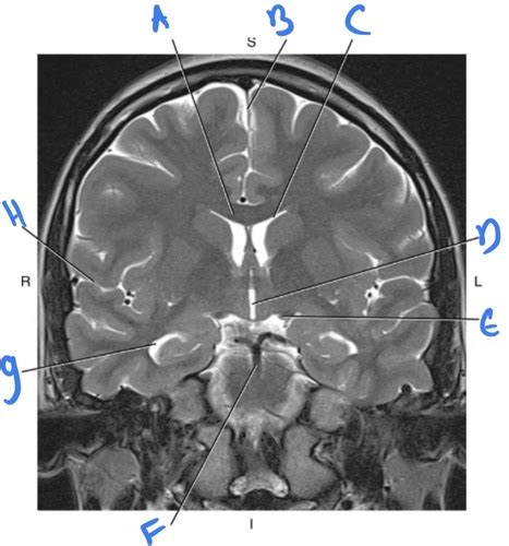 CsA Brain Good Flashcards Quizlet