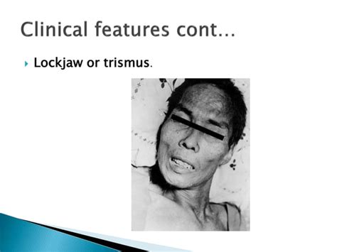 Tetanus Prophylaxis And Types Of Immunitynewnewv Pptx Infectious Tetanus Prophylaxis And Types Of Immunitynewnewv Pptx Infectious