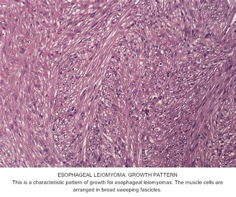 Pathology Outlines Leiomyoma