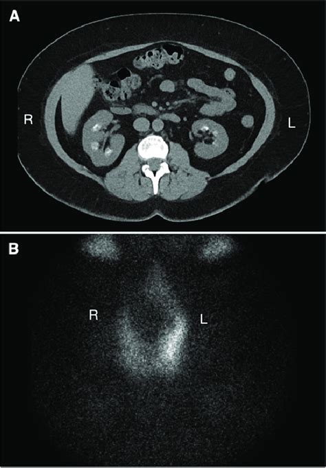 Computed Tomography Scan A Dual Energy Computed Tomography Scan Download Scientific