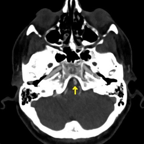 Basilar Artery Fenestration An Incidental Finding In A Patient With